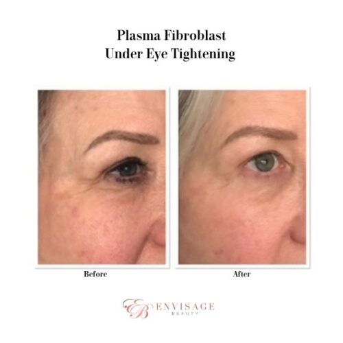 Fibroblast Plasma Skin Tightening Packages - Envisage Beauty